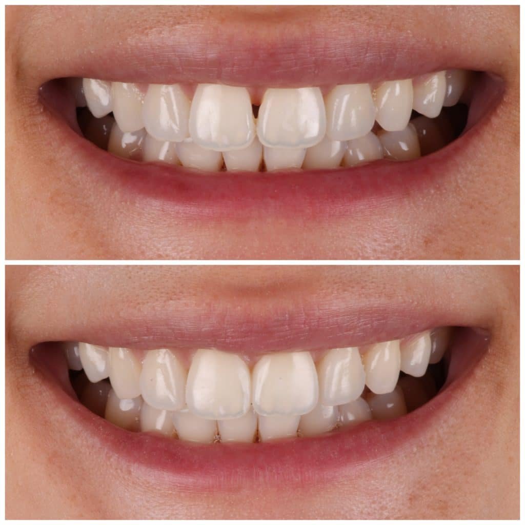 Close Black Triangles with the Bioclear Method