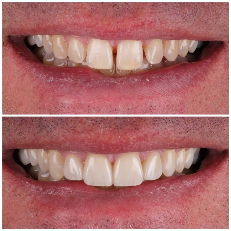 No Prep Veneers - Austin Artistic Dental | #1 Cosmetic Dentist in Austin