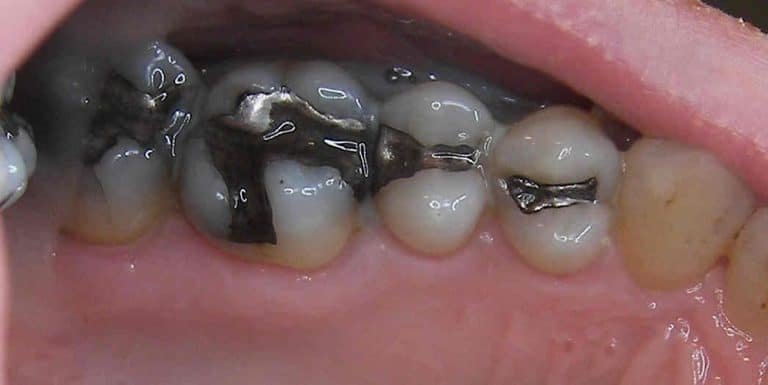 Onlay vs Crown | #1 Best Professional Dentist Austin