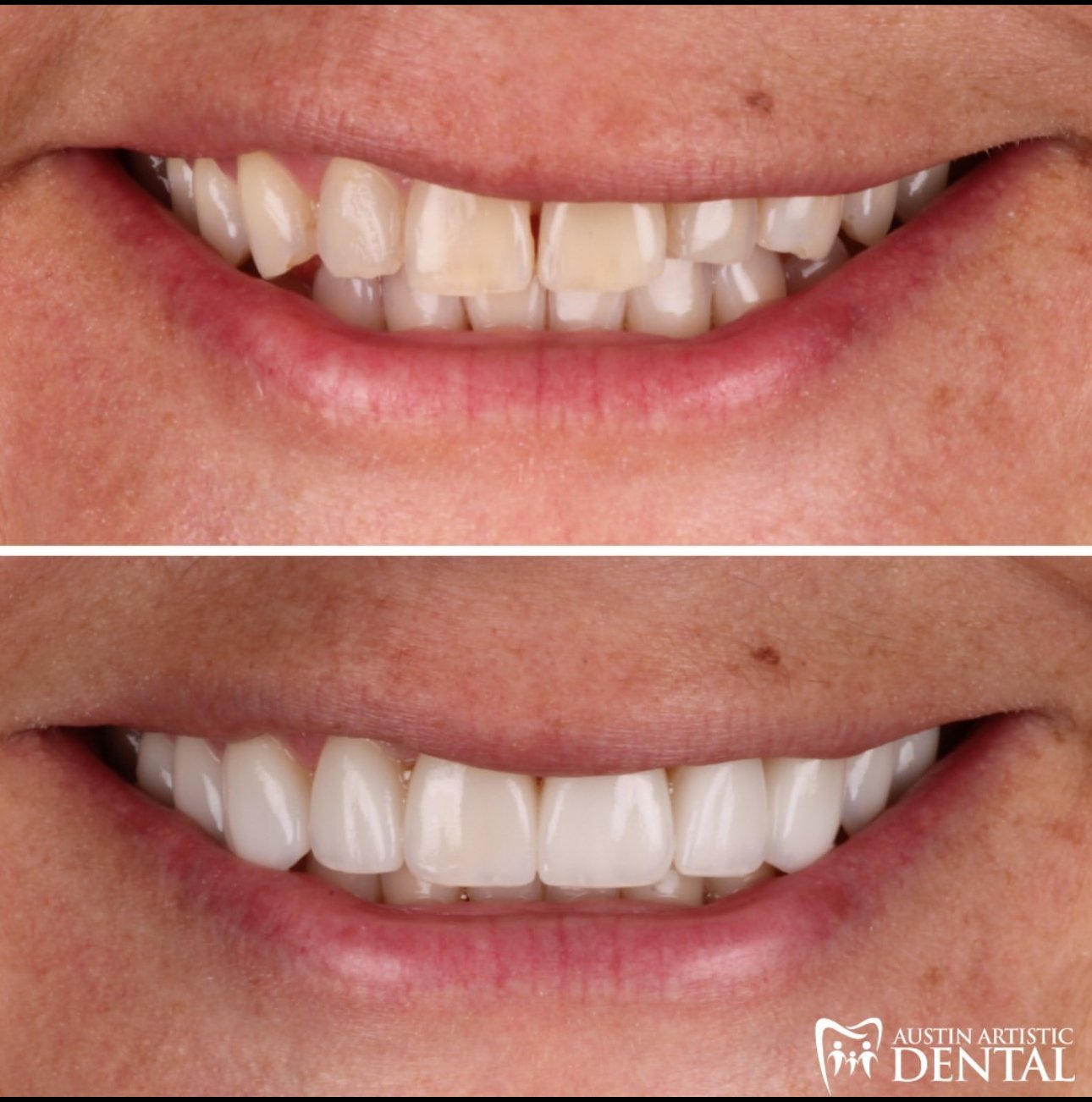 Smile Makeover Gallery| #1 Best Cosmetic Dentist Austin