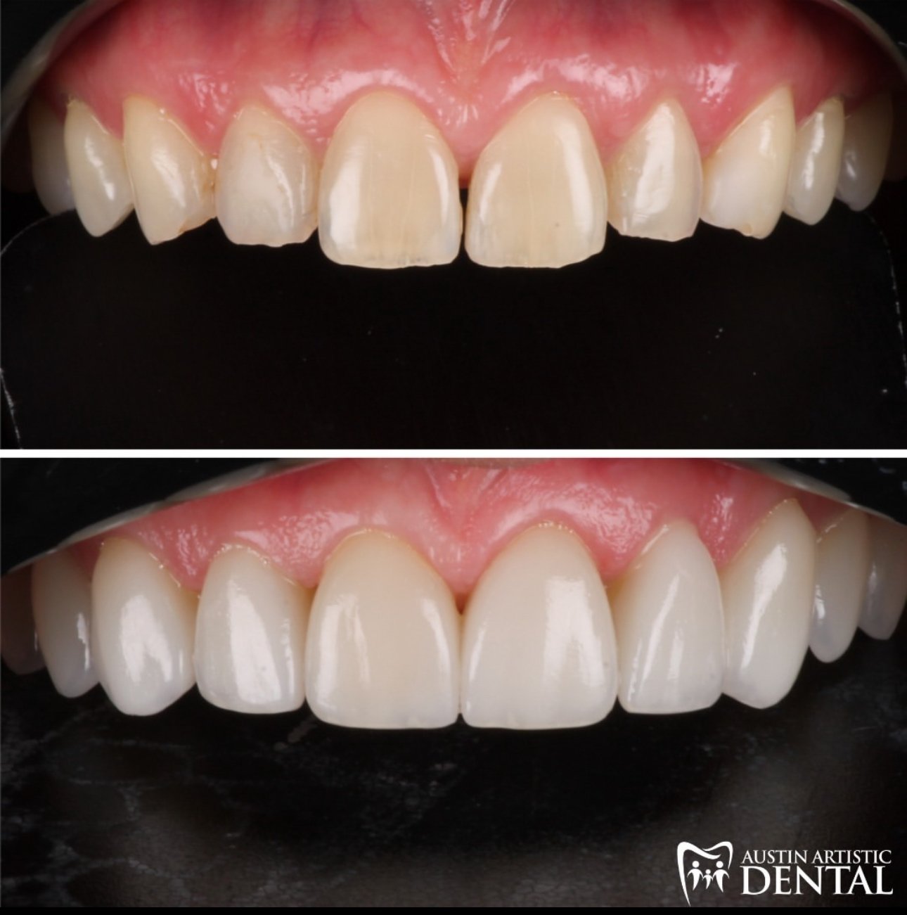 Smile Makeover Gallery| #1 Best Cosmetic Dentist Austin