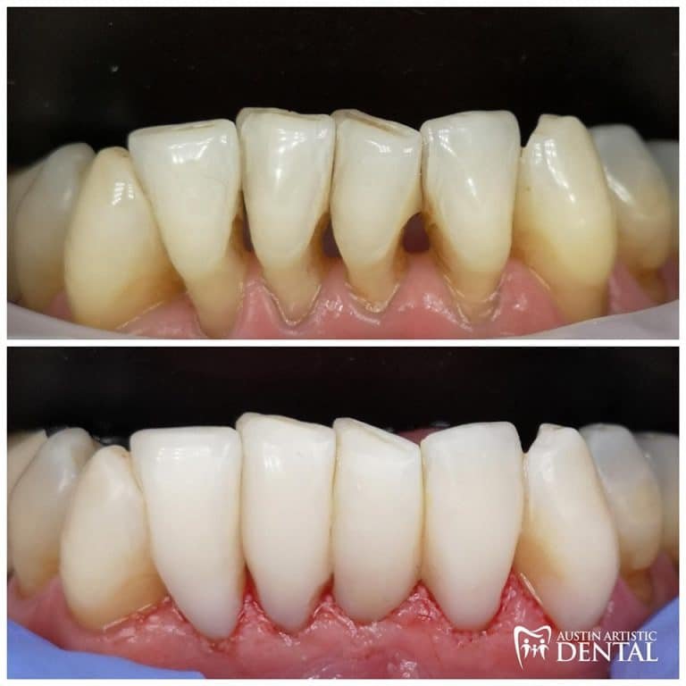 Close Black Triangles with the Bioclear Method