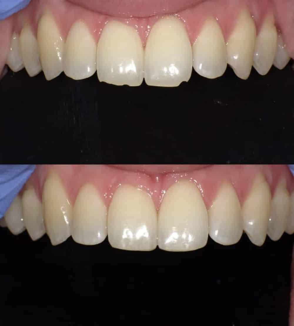 Smile Makeover | #1 Best Cosmetic Dentist Austin