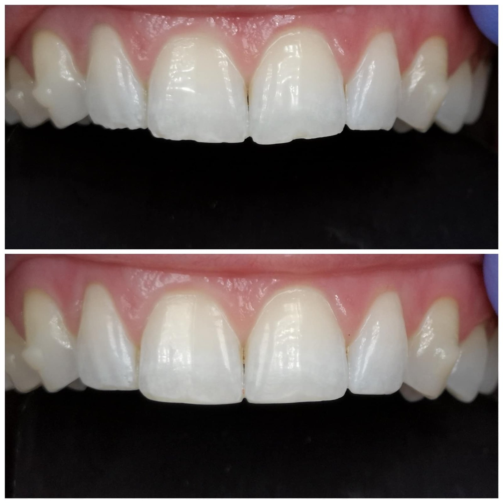 Smile Makeover | #1 Best Cosmetic Dentist Austin